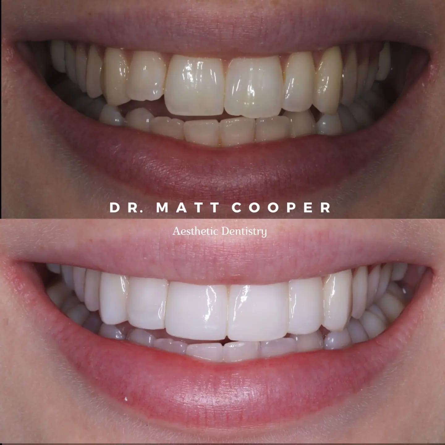 Composite Bonding | The Dental Practice at Dronfield Woodhouse